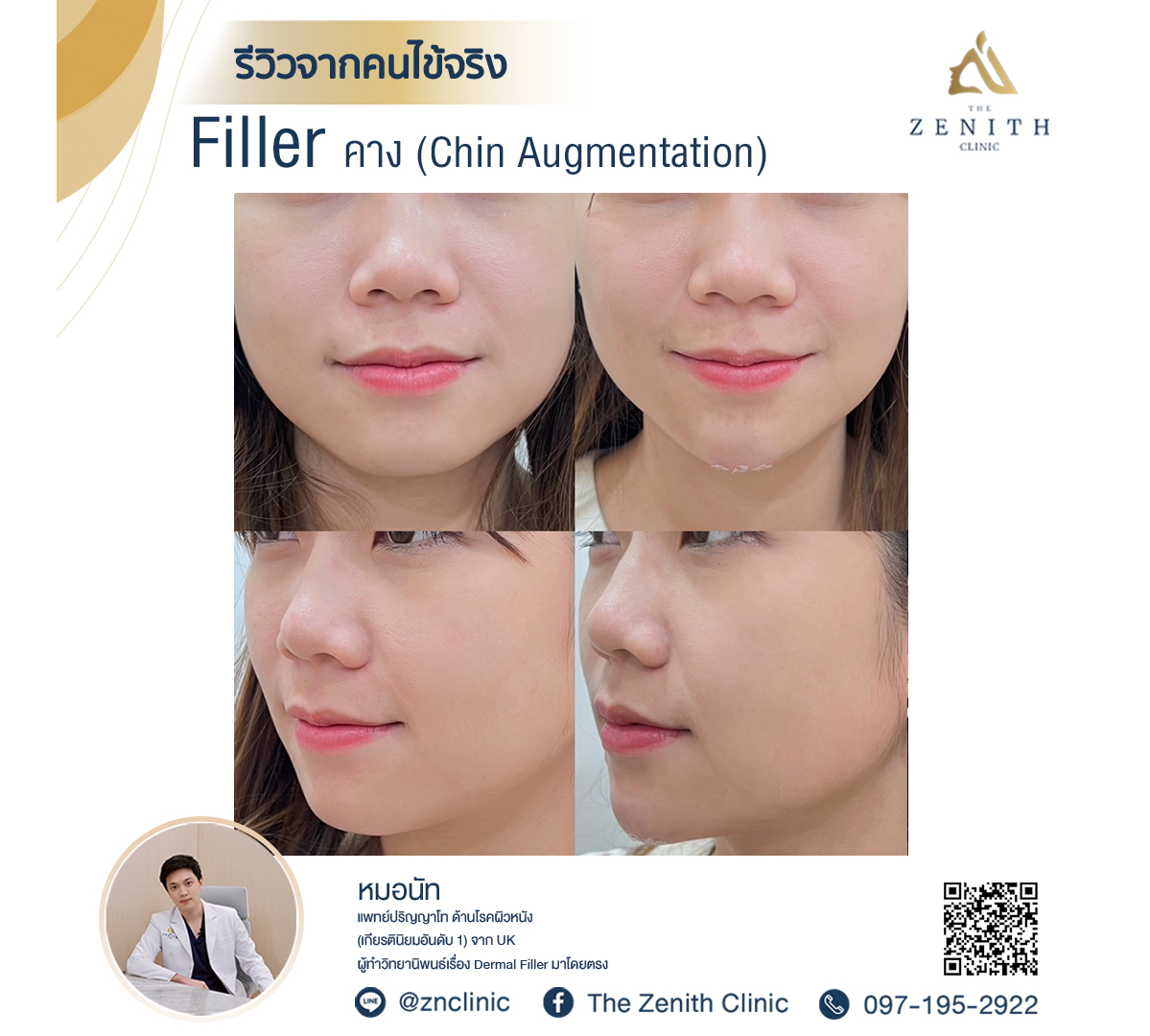 Filler คาง (Chin Augmentation) - THE ZENITH CLINIC