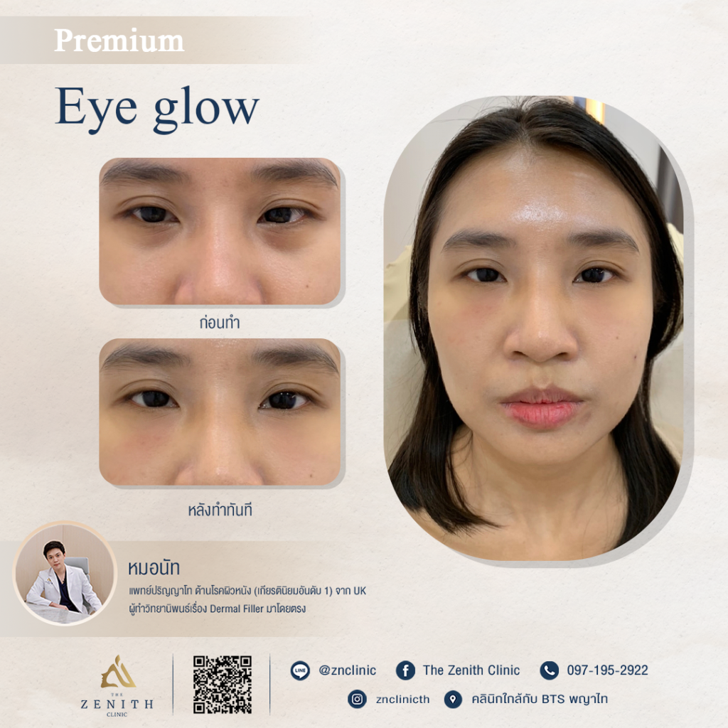 EYE GLOW - THE ZENITH CLINIC